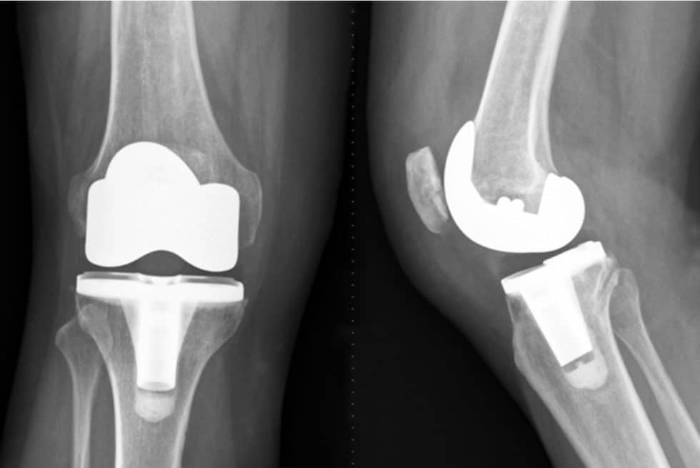 Total Knee Replacement and Pre-Operative Preparation - Pro Physical Therapy